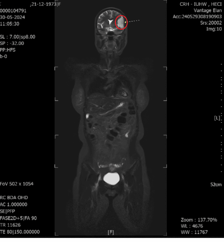 PHÁT HIỆN SỚM ĐỘT QUỴ, UNG THƯ BẰNG CHỤP MRI, MRI DWIBS TOÀN THÂN - Bệnh viện Chợ Rẫy